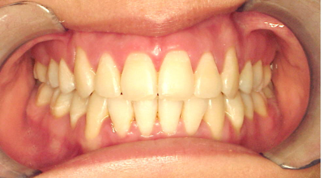 Before & After - Mission City Orthodontics